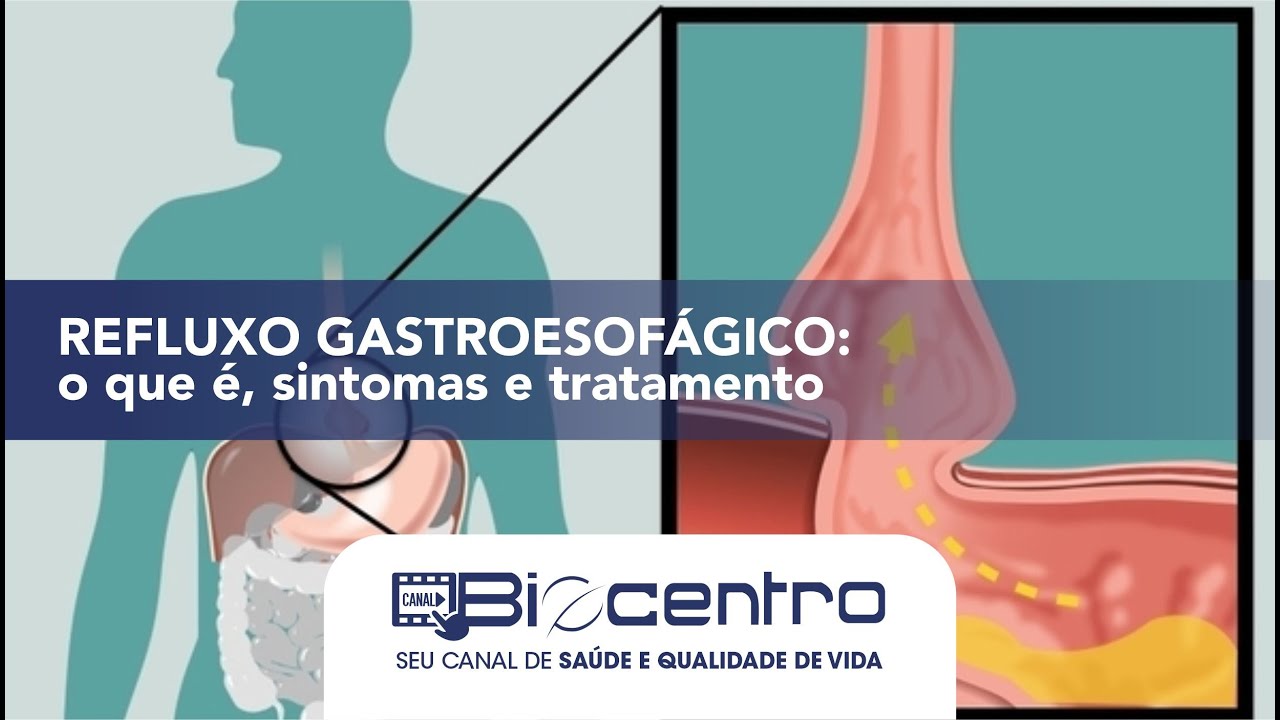 Refluxo gastroesofágico: o que é, sintomas e tratamento - YouTube