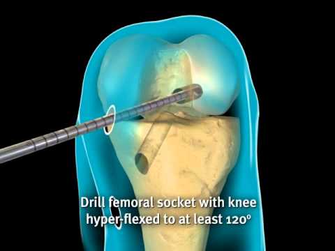 AperFix II AM - YouTube