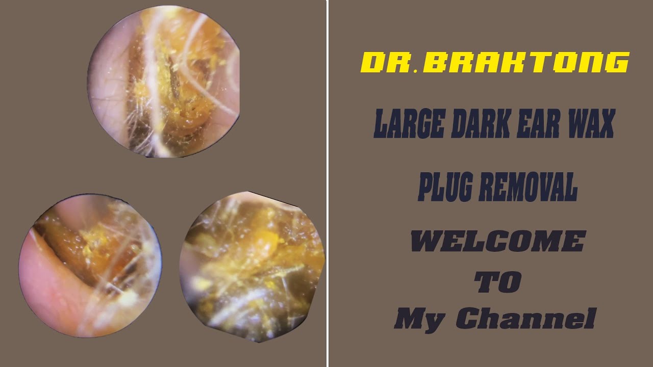 LARGE DARK EAR WAX WE'VE GOT ONE PATIENT IN THIS VIDEO#013 - YouTube