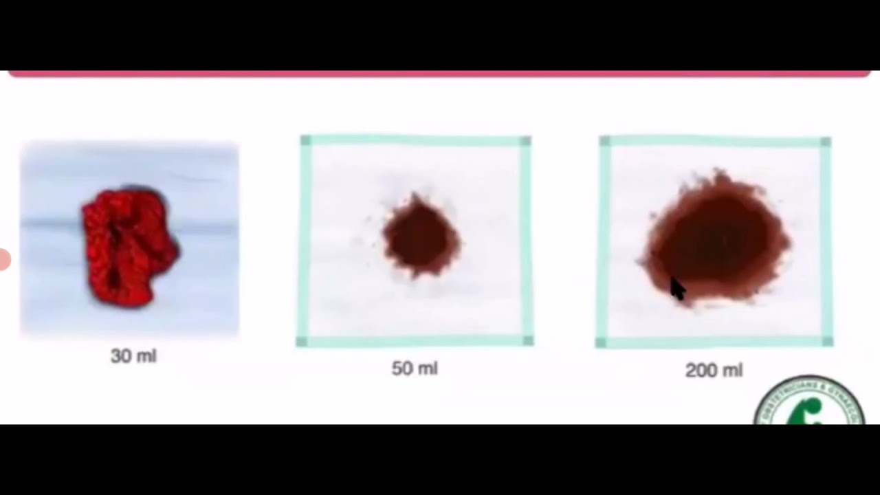 VISUAL ASSESSMENT OF BLOOD LOSS - YouTube