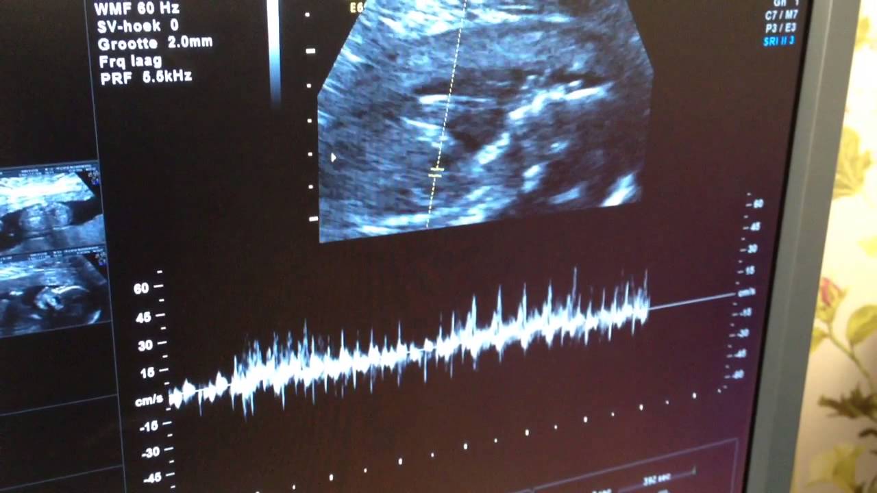 20 weken echo (20 weeks echo) - YouTube
