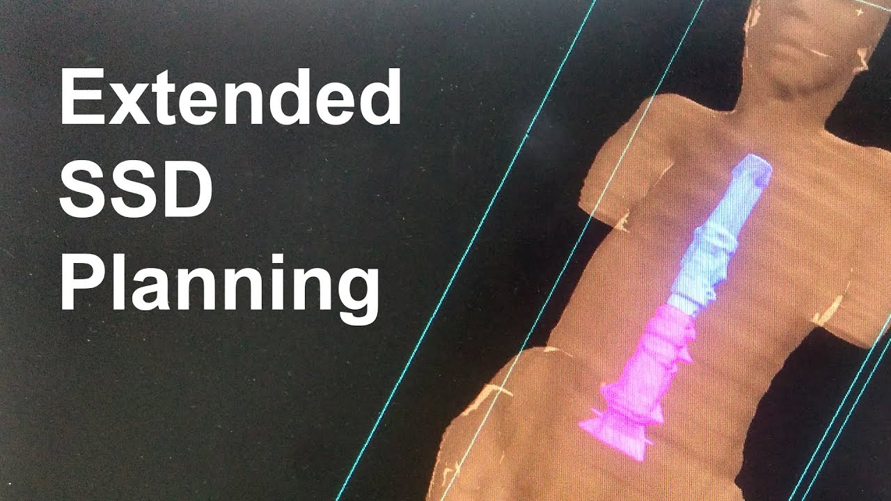 Extended SSD (Source Surface Distance) Planning - YouTube