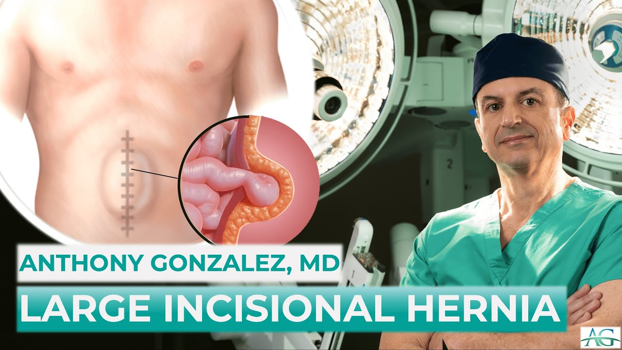 Large Incisional Hernia and Treatment (English) - YouTube