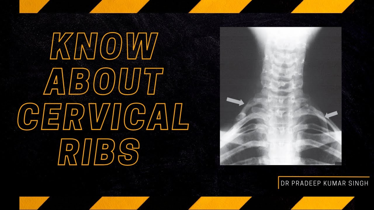 Know About Cervical Ribs/ Thoracic Outlet Syndrome /Dr. Pradeep Kumar ...