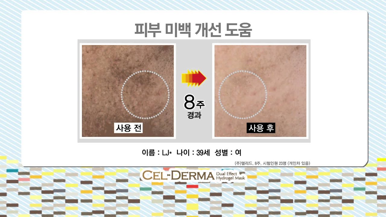 셀더마(CEL-DERMA) 임상 영상 - YouTube