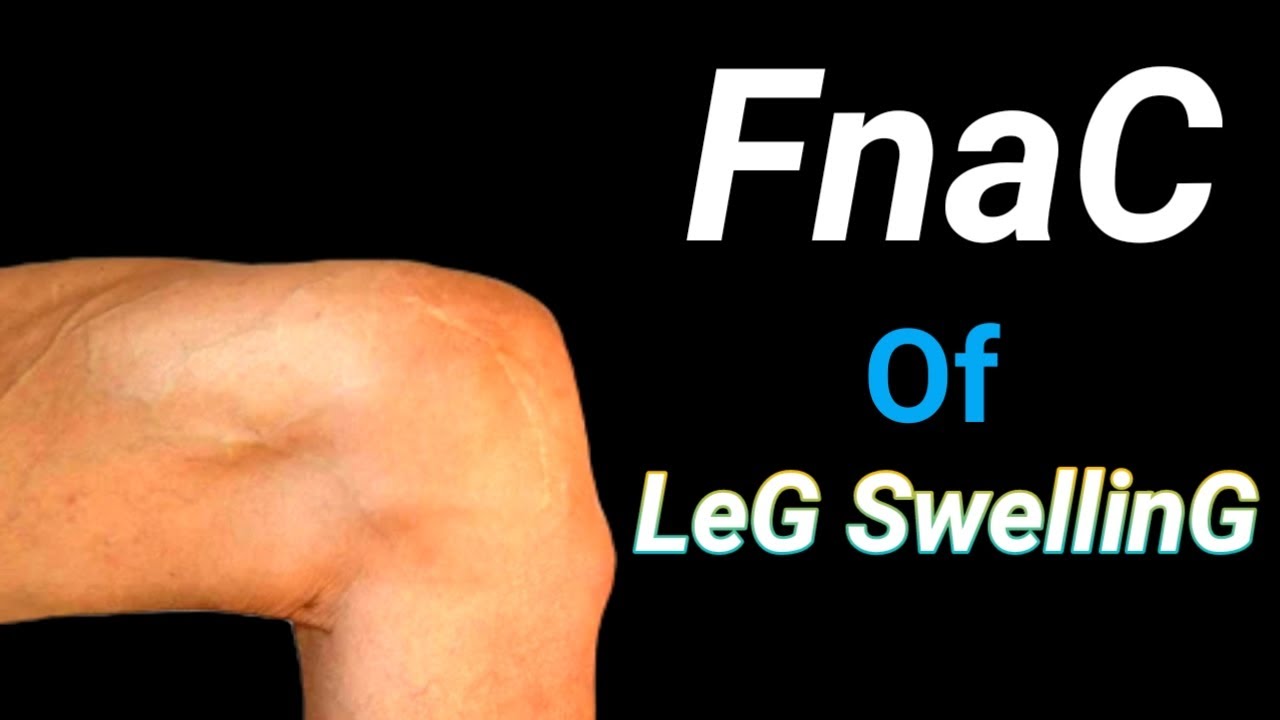 FNAC Of Lump In Legs Swelling।। - YouTube