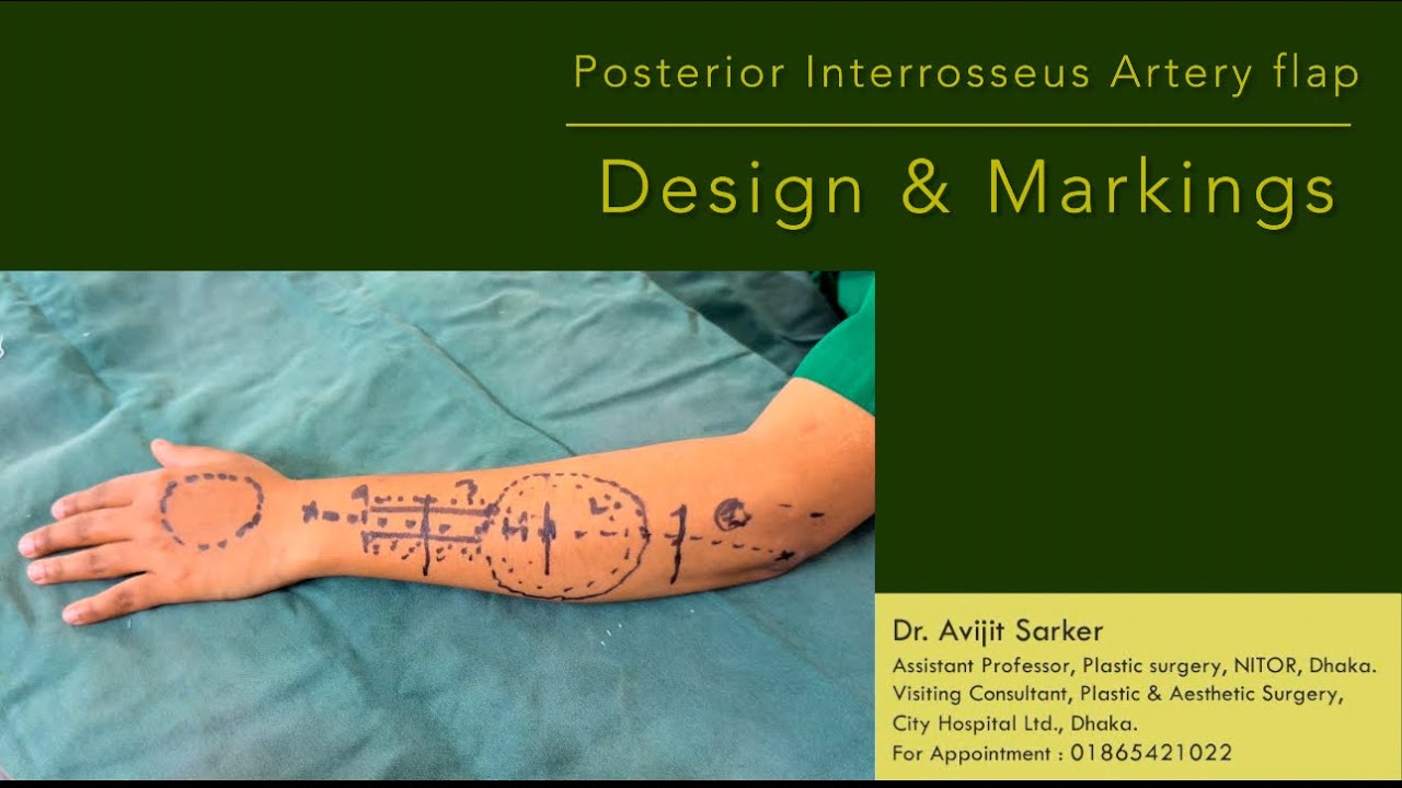 Posterior interosseus artery (PIA) flap : How to design!!!! - YouTube