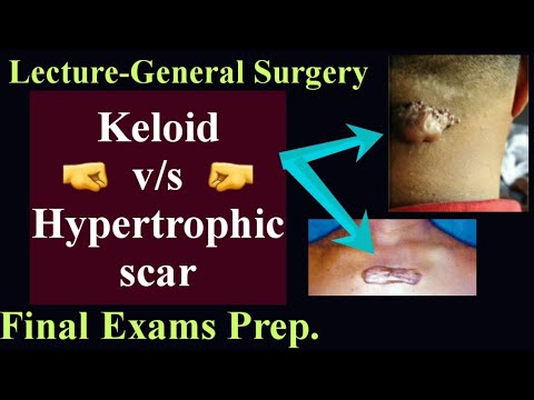 Scar and Keloid Management, Hypertrophic and Keloid scars Treatment ...