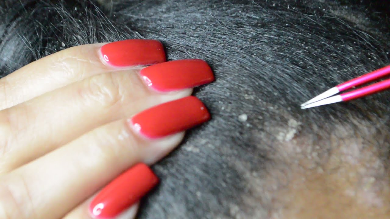 Dandruff Scratching Session (w Tweezers) - YouTube