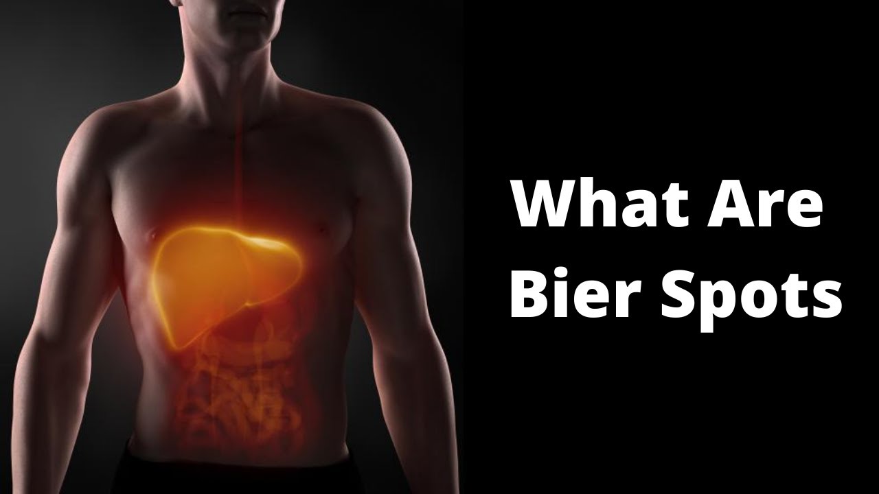 What Are Bier Spots - YouTube