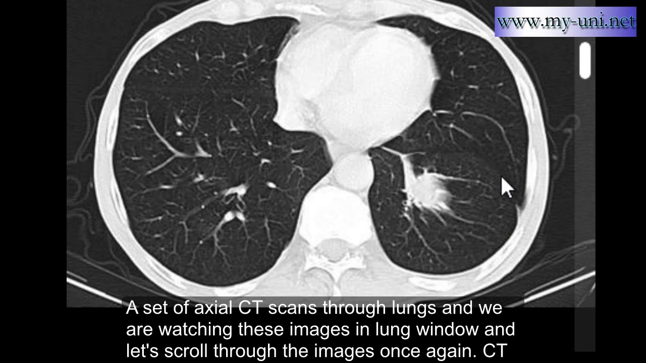 CT chest : Round atelectasis ( by hammadshams ) - YouTube