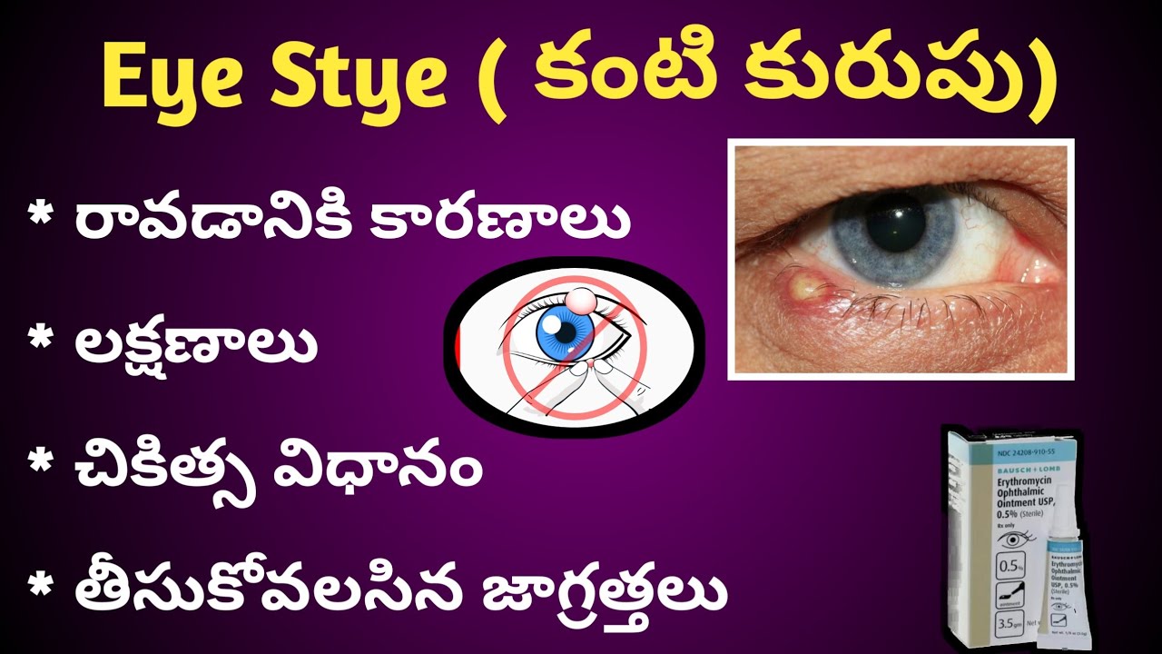 Do's and Don'ts of Eye Stye (కంటి కురుపు) in Telugu - YouTube