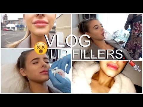 VLOG: LIP FILLERS & A DAY IN THE LIFE