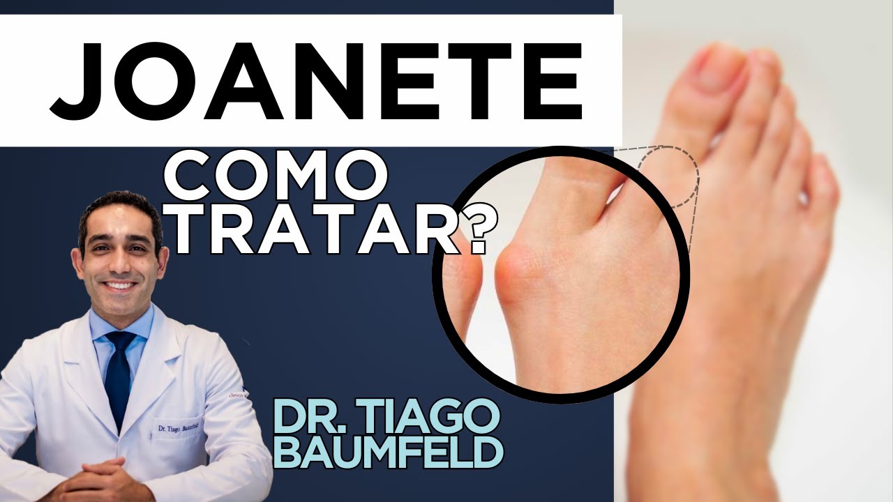 Cirurgia para Joanete: Hallux Valgus o que é e como funciona? - YouTube