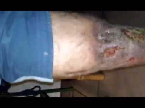 CDM-KIEV-Sanya - leg ulcer