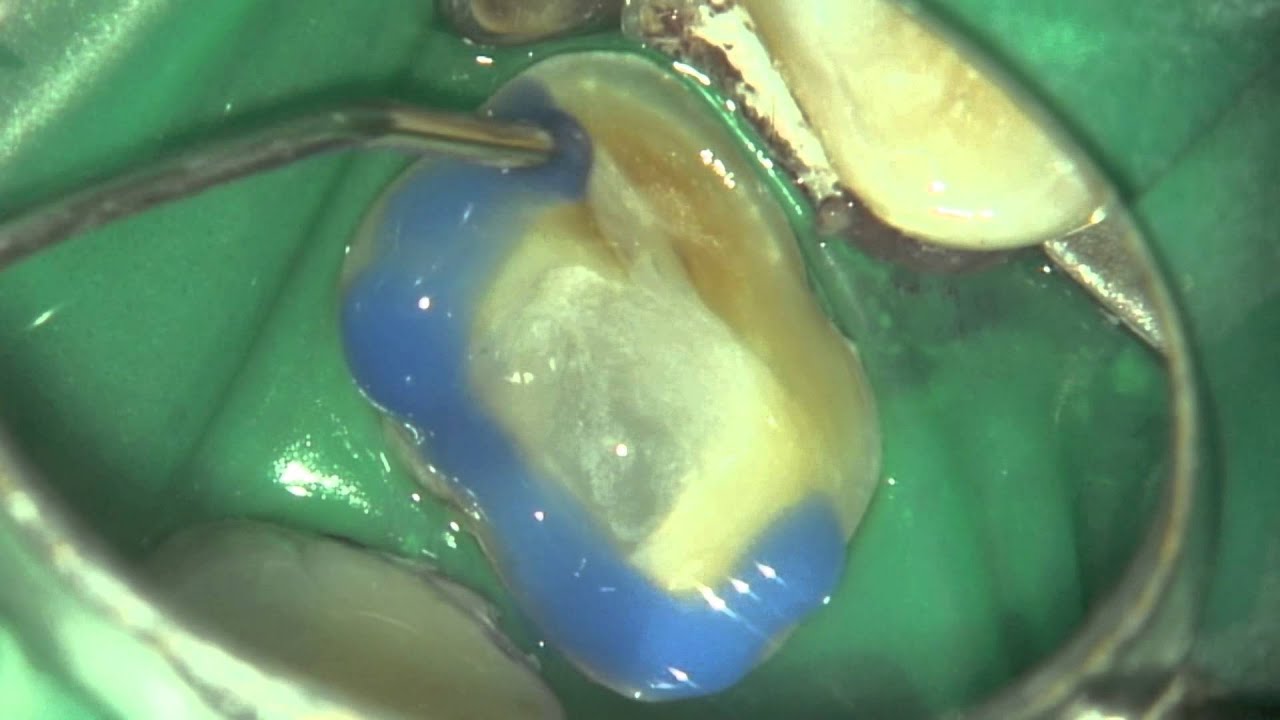 cerec onlay tooth #14 - YouTube