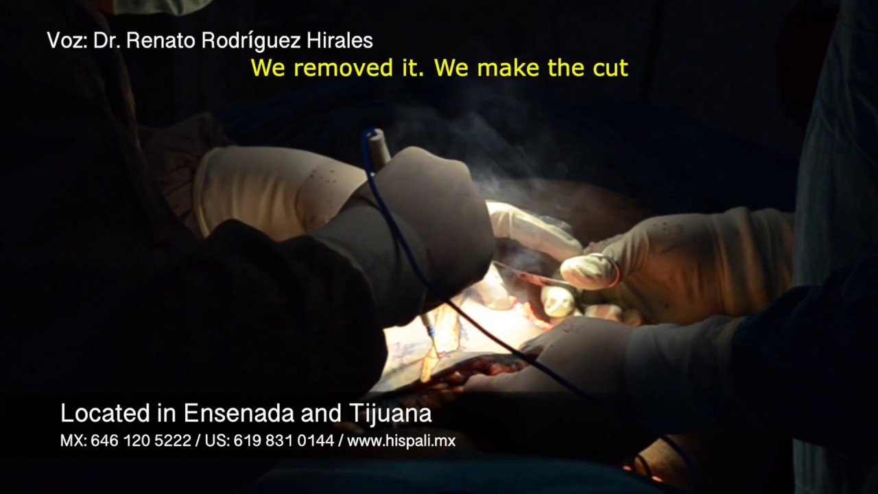 Lipectomía en T invertida - Cirugía Estética con Dr. Baja - YouTube