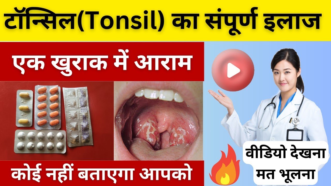 सिर्फ यह 4 Tablet खालो दो दिन में टॉन्सिल (Tonsil) जड़ से खत्म हो ...