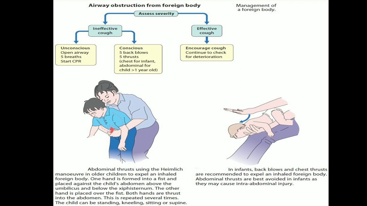 Heimlich Maneuver Theory - YouTube