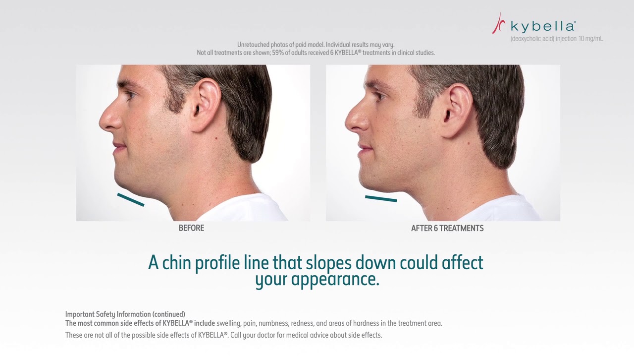 Kybella Video - YouTube