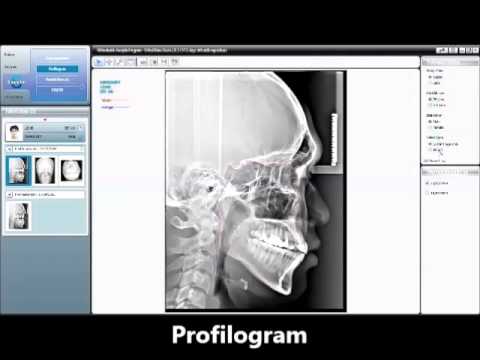 Introducing OrthoVision by Vatech - YouTube