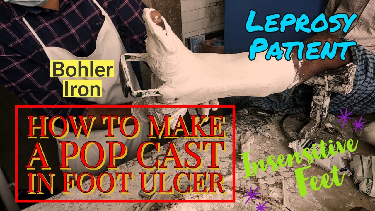 PoP cast making in Leprosy Patients with foot ulcer - Management of ...