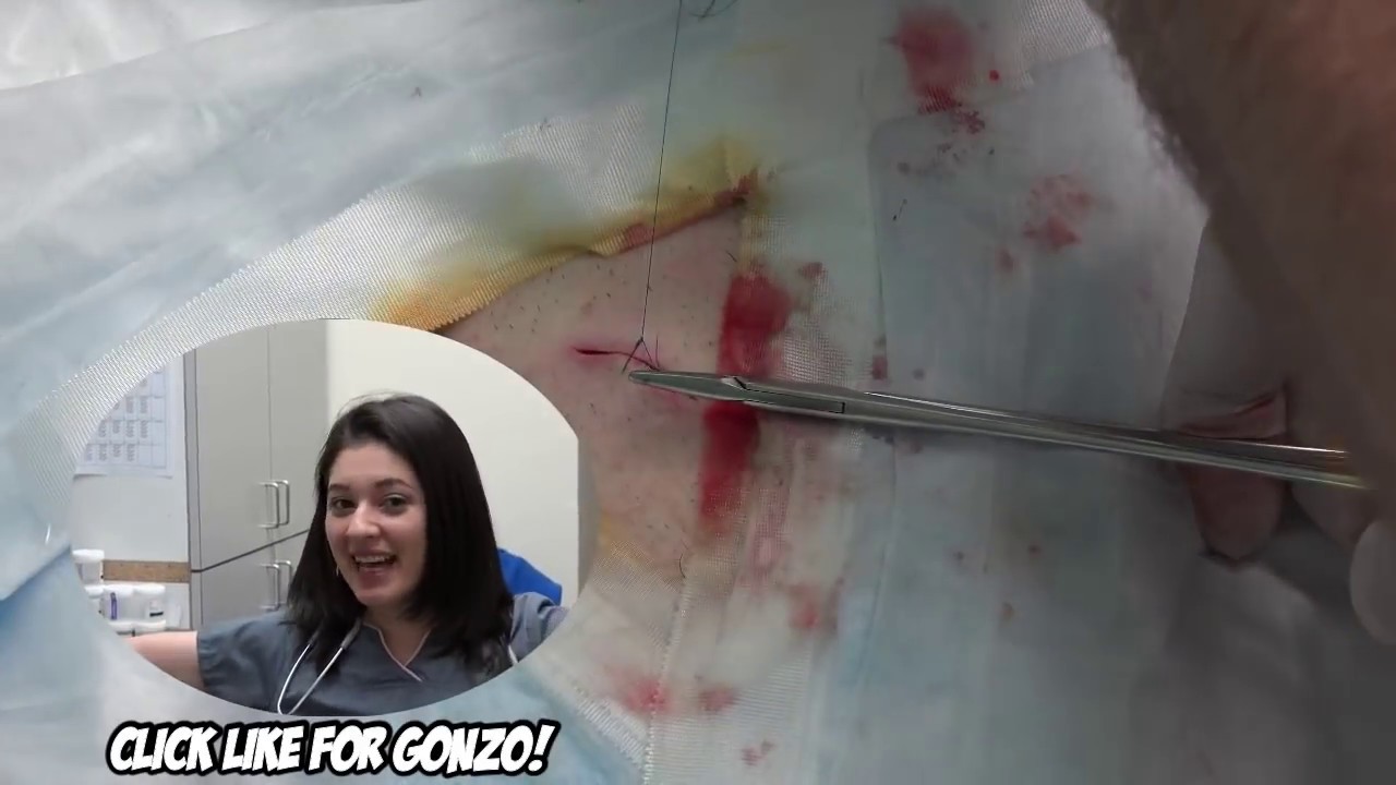 Cyst Removal! Busy Bee Highlights - Treatment, Popping, Dr. Cyst Buster ...