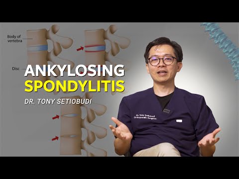 🔴 PUNGGUNG KAKU AKIBAT ANKYLOSING SPONDILITIS ATAU BAMBOO SPINE 🔴 | DR TONY SETIOBUDI