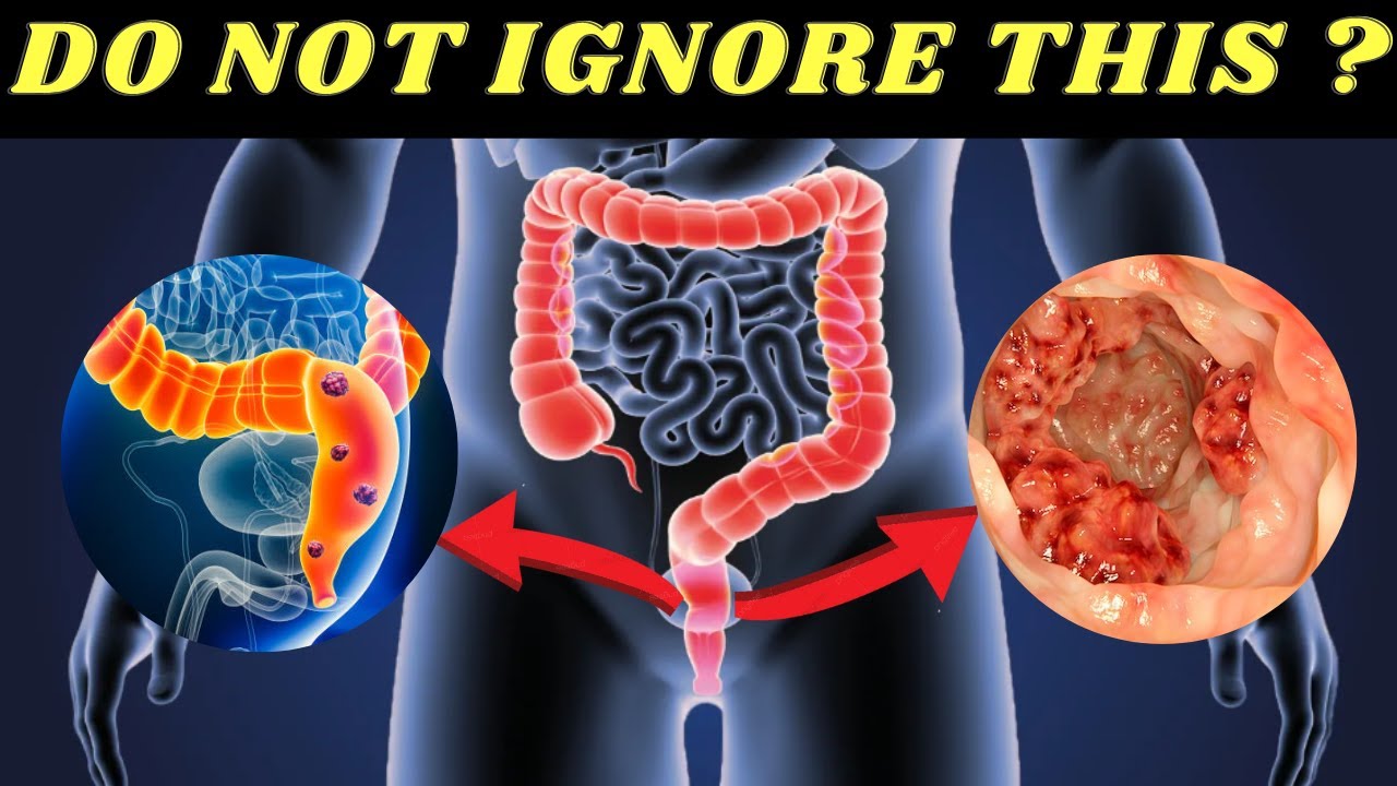 Early Warning Signs Of Colon Cancer You Should Not Ignore - YouTube