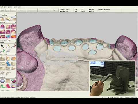 Introduction to Removable Partial Denture Design - YouTube