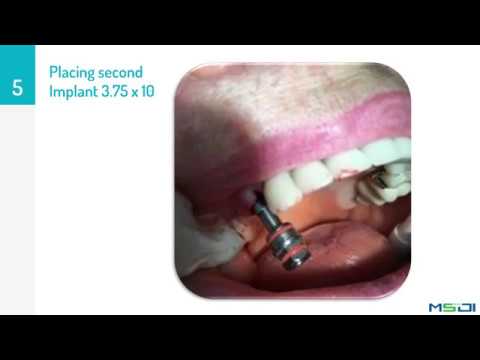 Implantation Procedure using MSDI dental implants (Alef Implant) - by Dr. Raul Rojas - YouTube