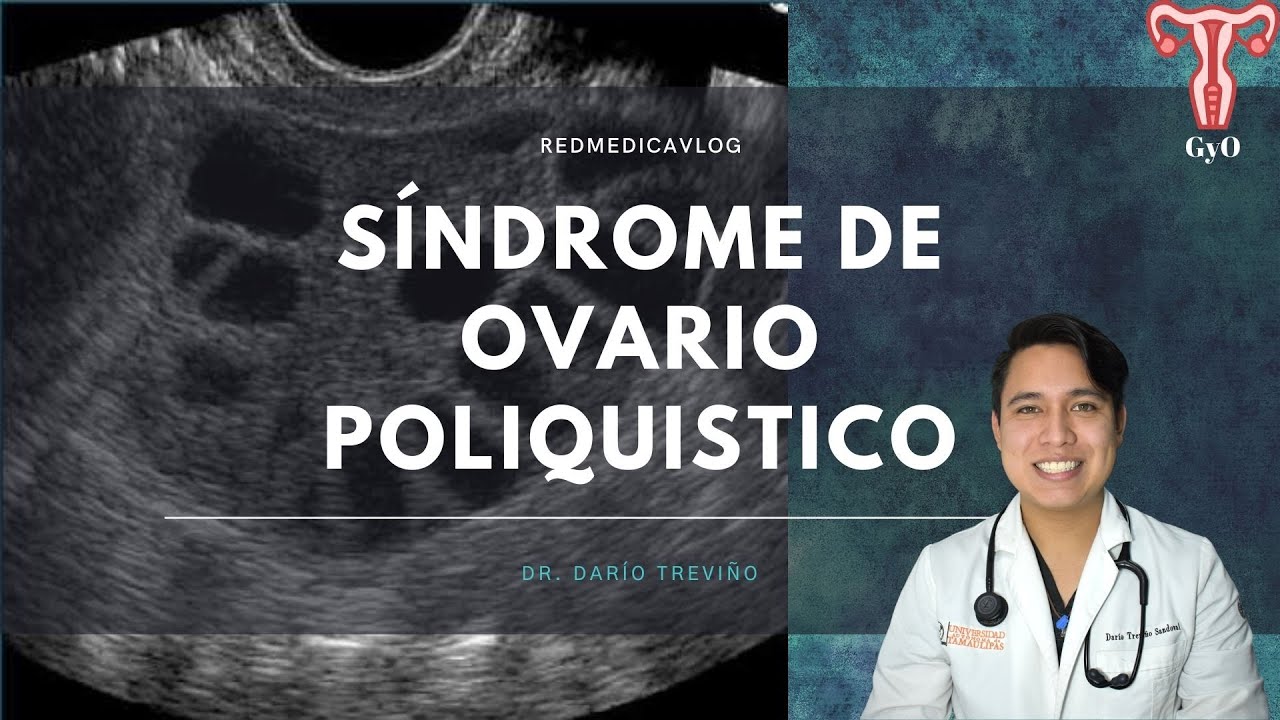 Síndrome de ovario poliquístico | #ENARM | Dr. Treviño - YouTube