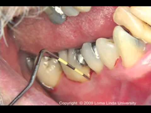 Endodontics Torabinejad 6-2 Perio of Perio Origin - YouTube