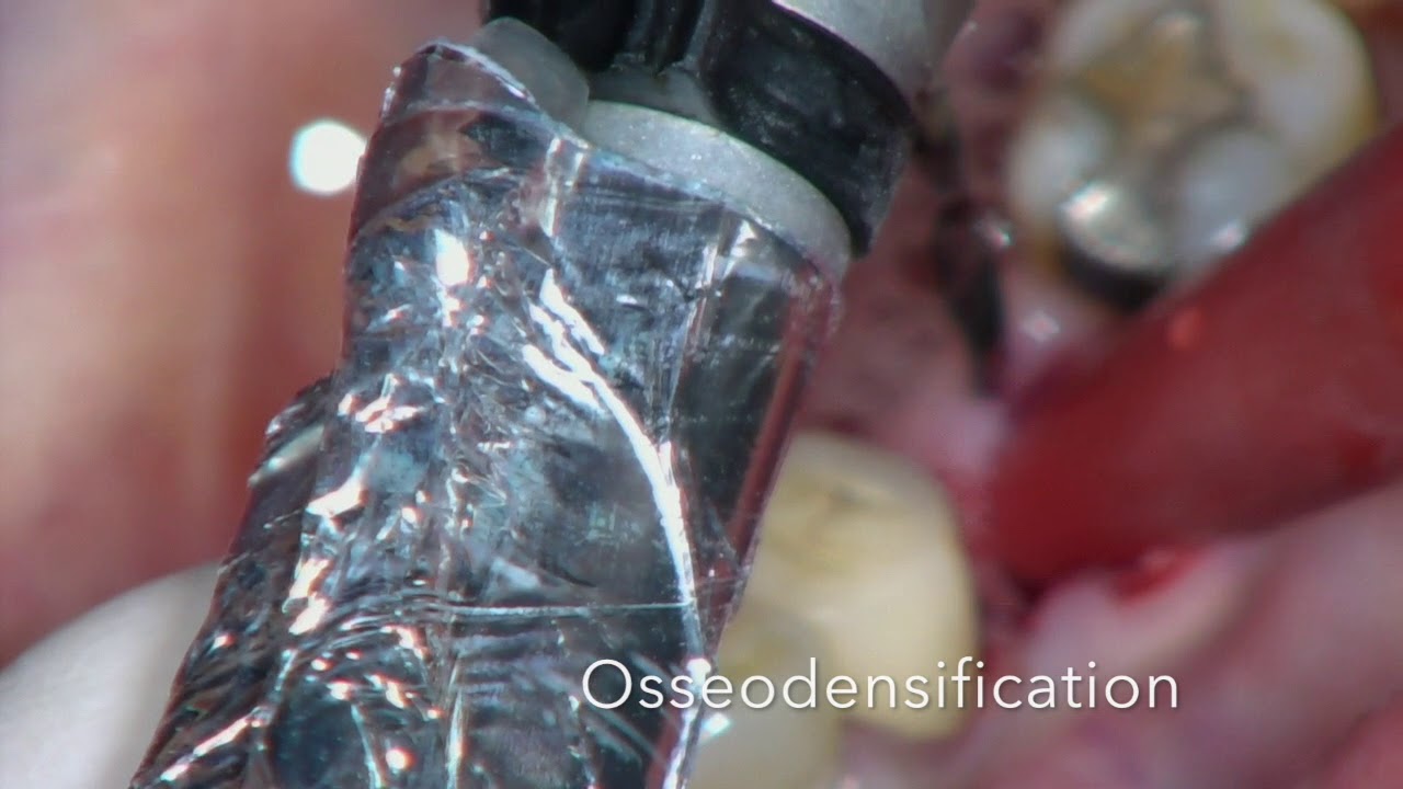 Immediate Placement: Mandibular Molar - YouTube