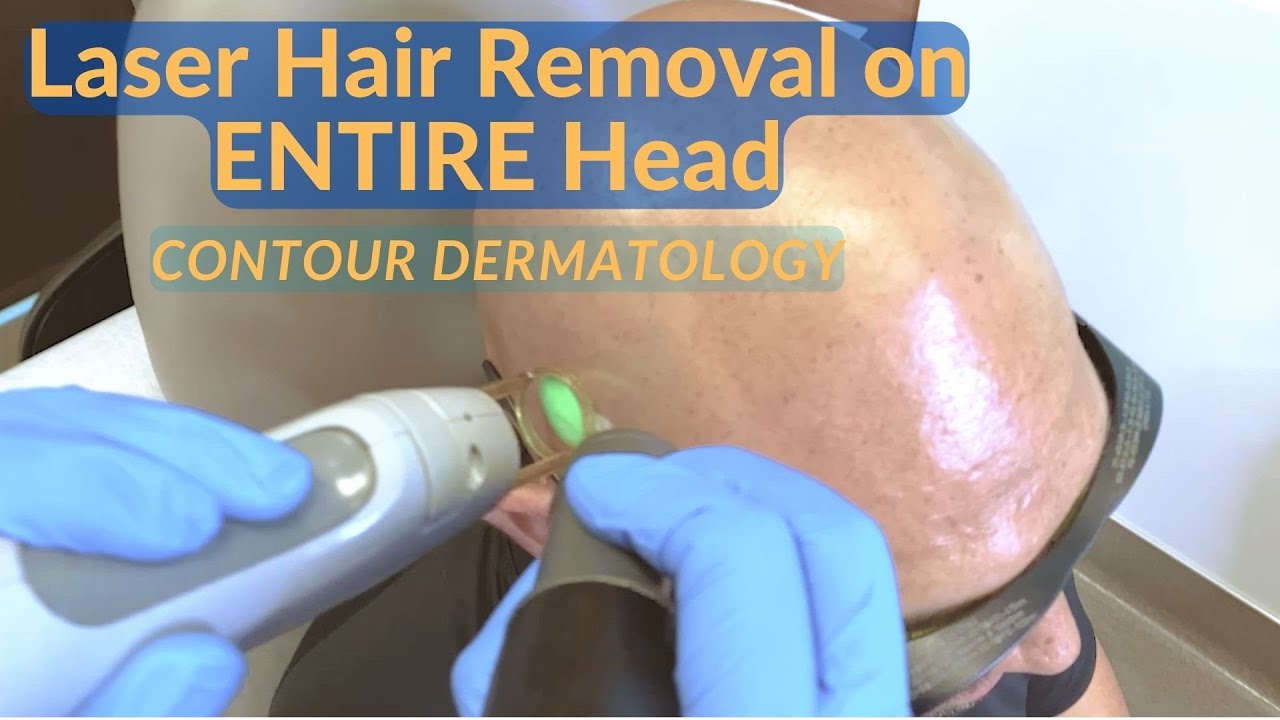 He Wanted His Entire Head Treated with Laser Hair Removal! - YouTube