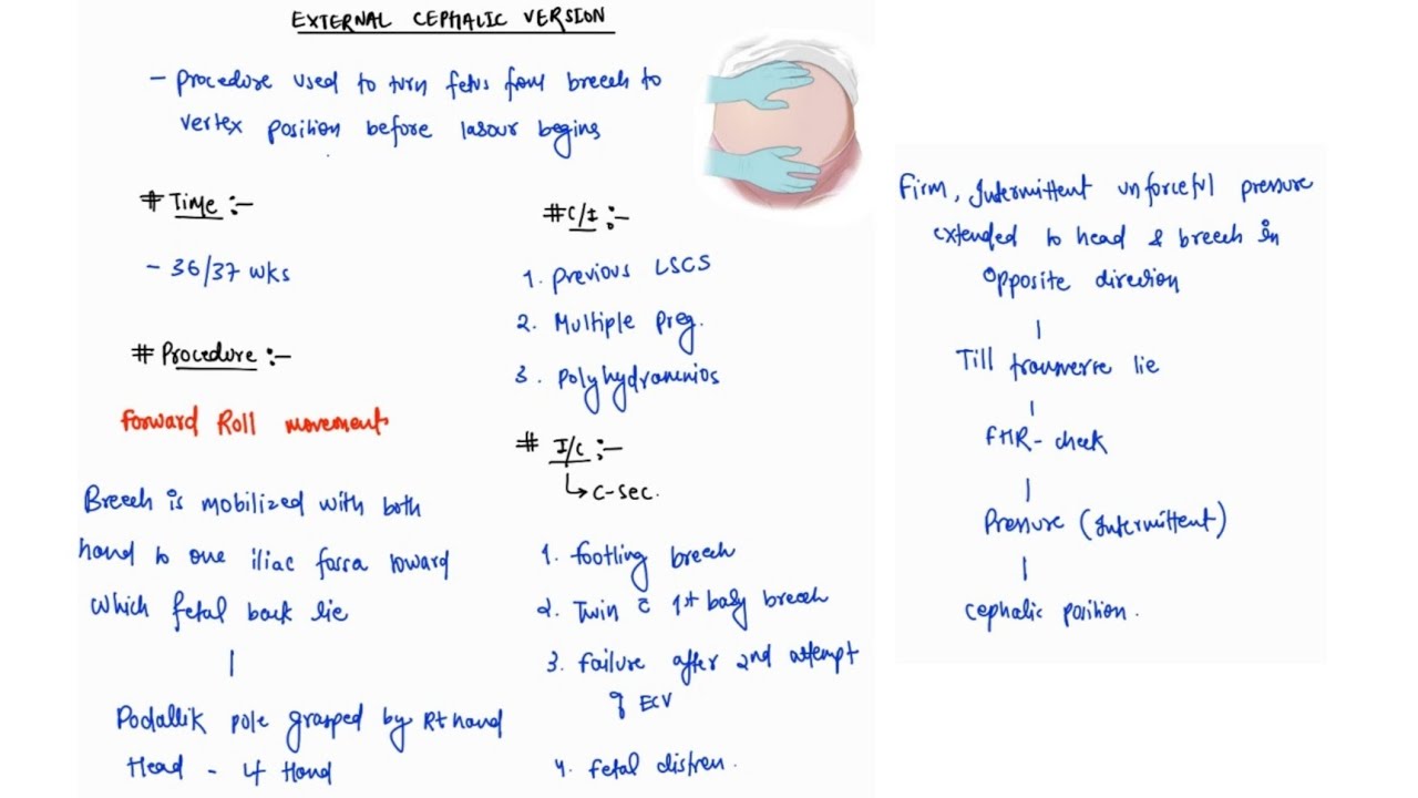 EXTERNAL CEPHALIC VERSION NOTES | OBSTETRICS | OBGY | ONE PAGE NOTES ...