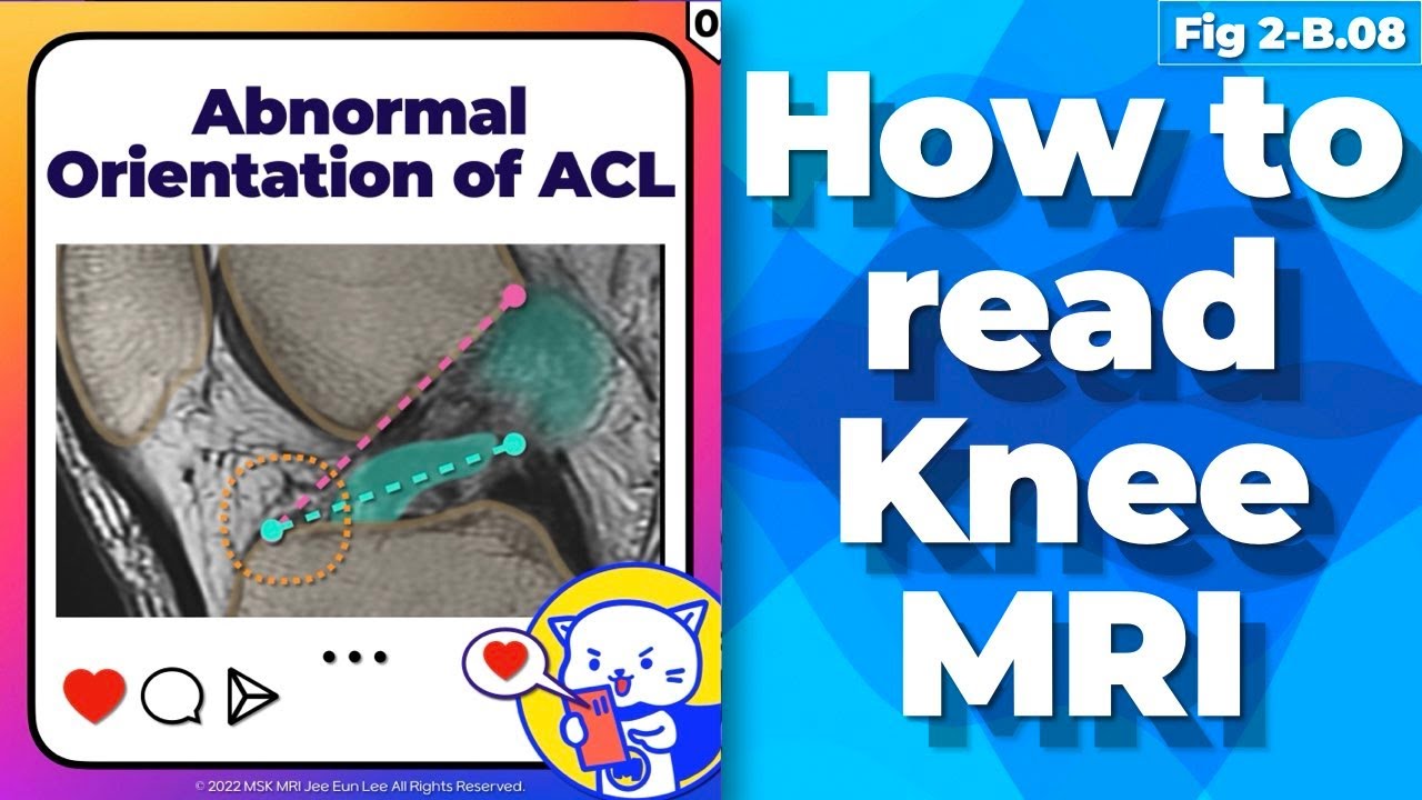 (Fig 2-B.08) Abnormal orientation or bowing of the ACL - YouTube