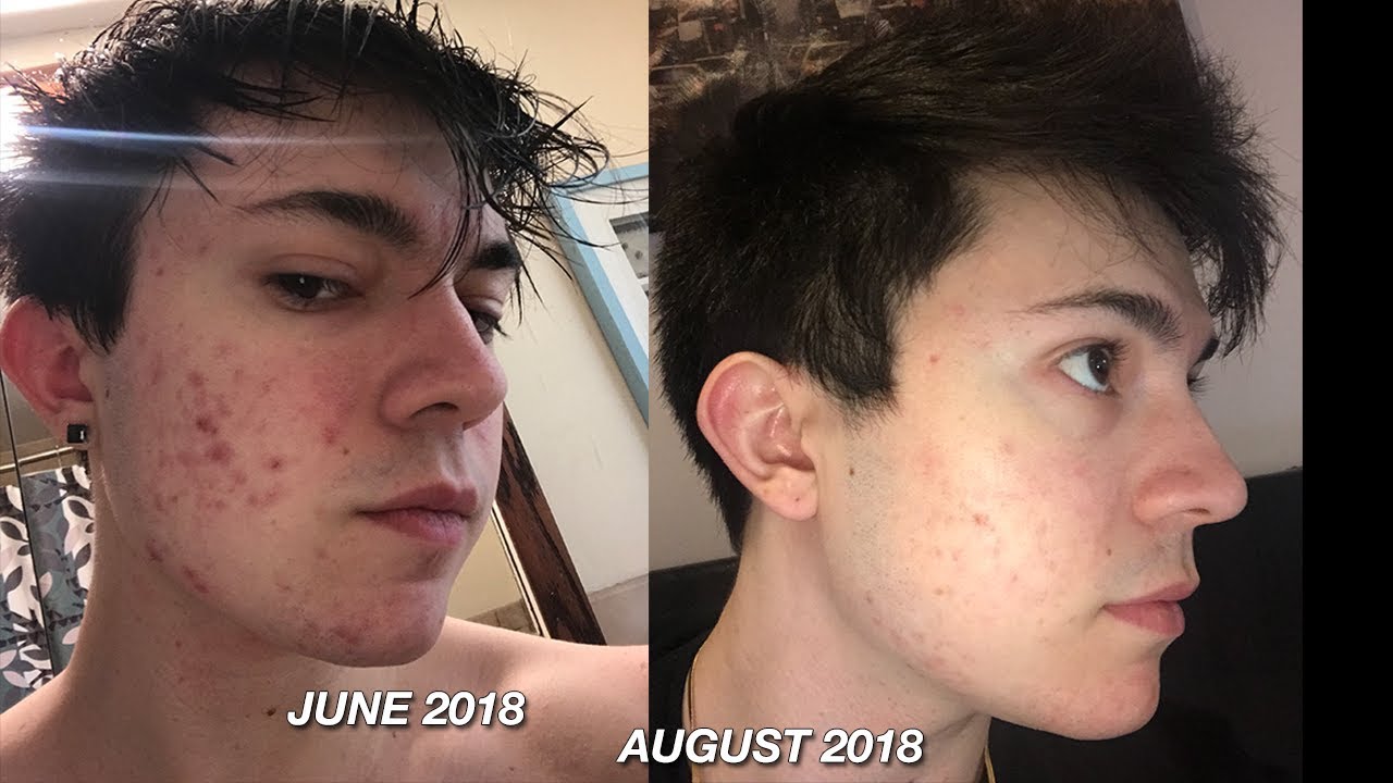 MY SKIN CLEARED UP IN 2 MONTHS - YouTube