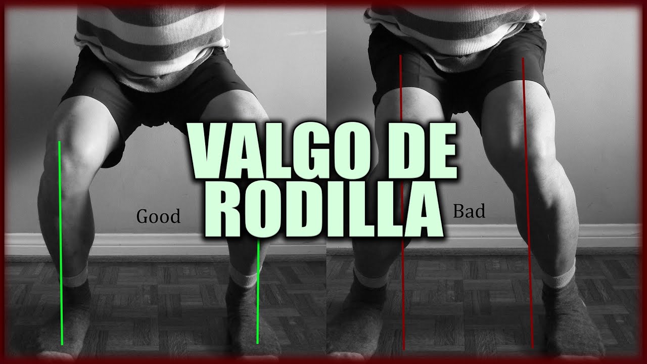 ️ VALGO DE RODILLA en SENTADILLA || Qué es, Cómo evitarlo y Ejercicios ...