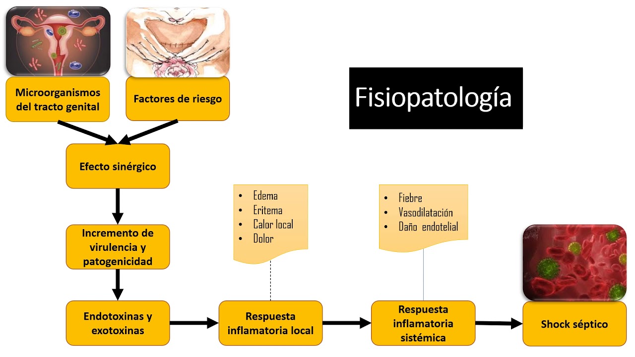 sepsis puerperal obstetricia - YouTube