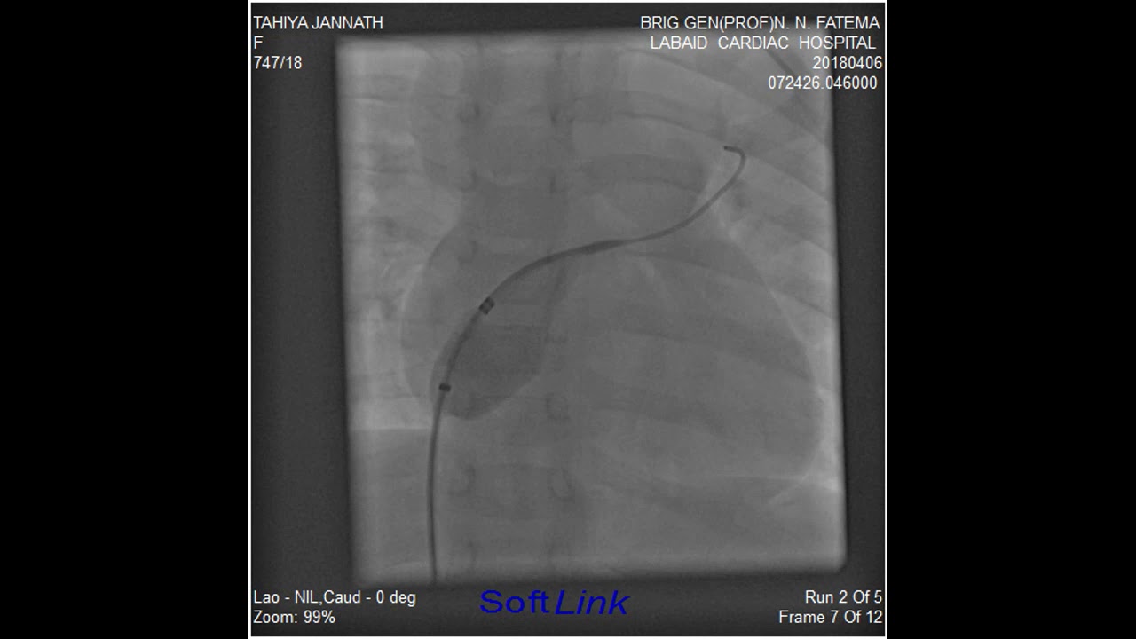 Baby Tahia 02 Y 12 5 Kg Large ASD II Balloon Sizing Angio - YouTube