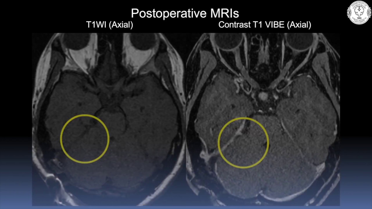 Retrosigmoid transmeatal and suprajugular approach for cerebellopontine ...