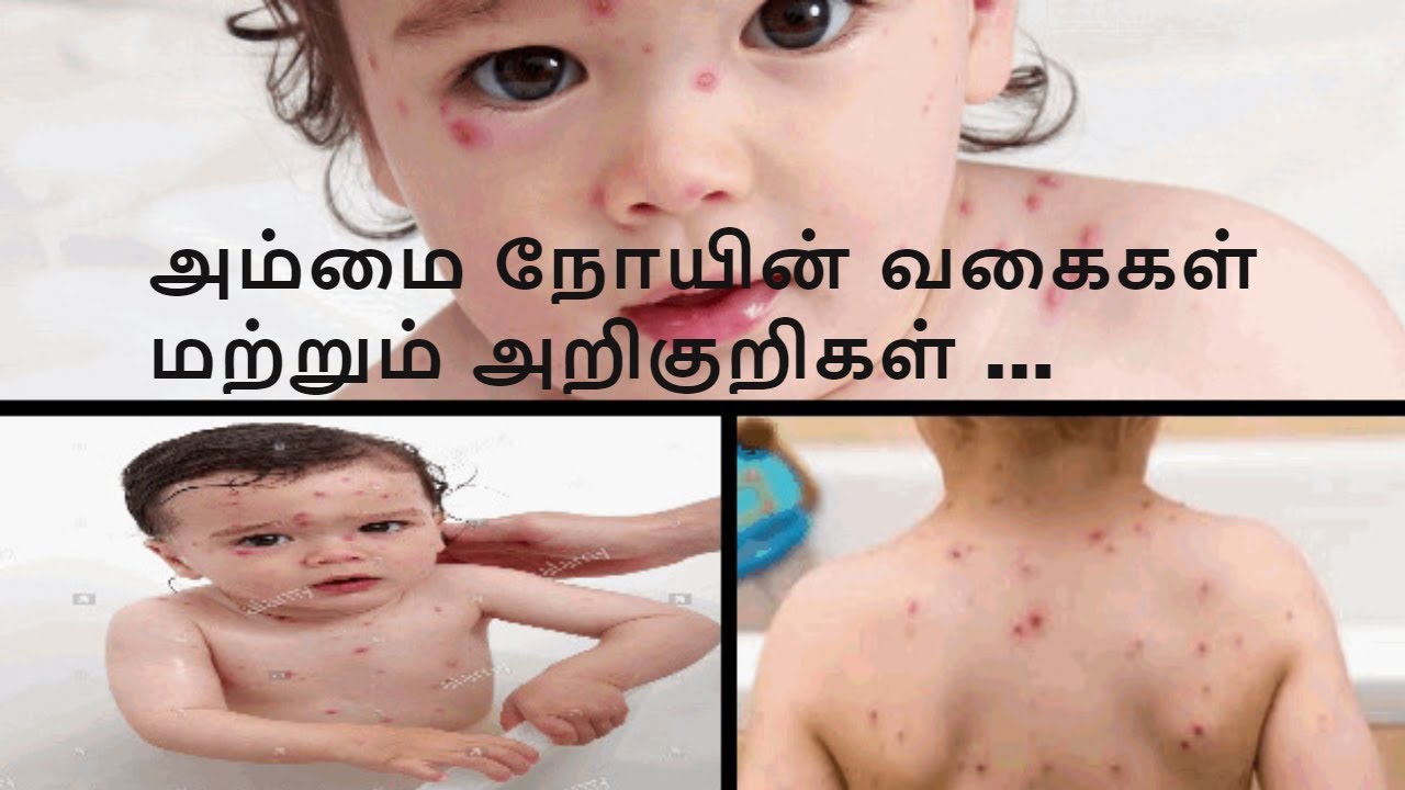 Chicken pox types and symptoms/அம்மை நோயின் வகைகள் மற்றும் அறிகுறிகள் ...