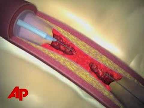 Study: Vacuum Technology Aids Heart Patients - YouTube