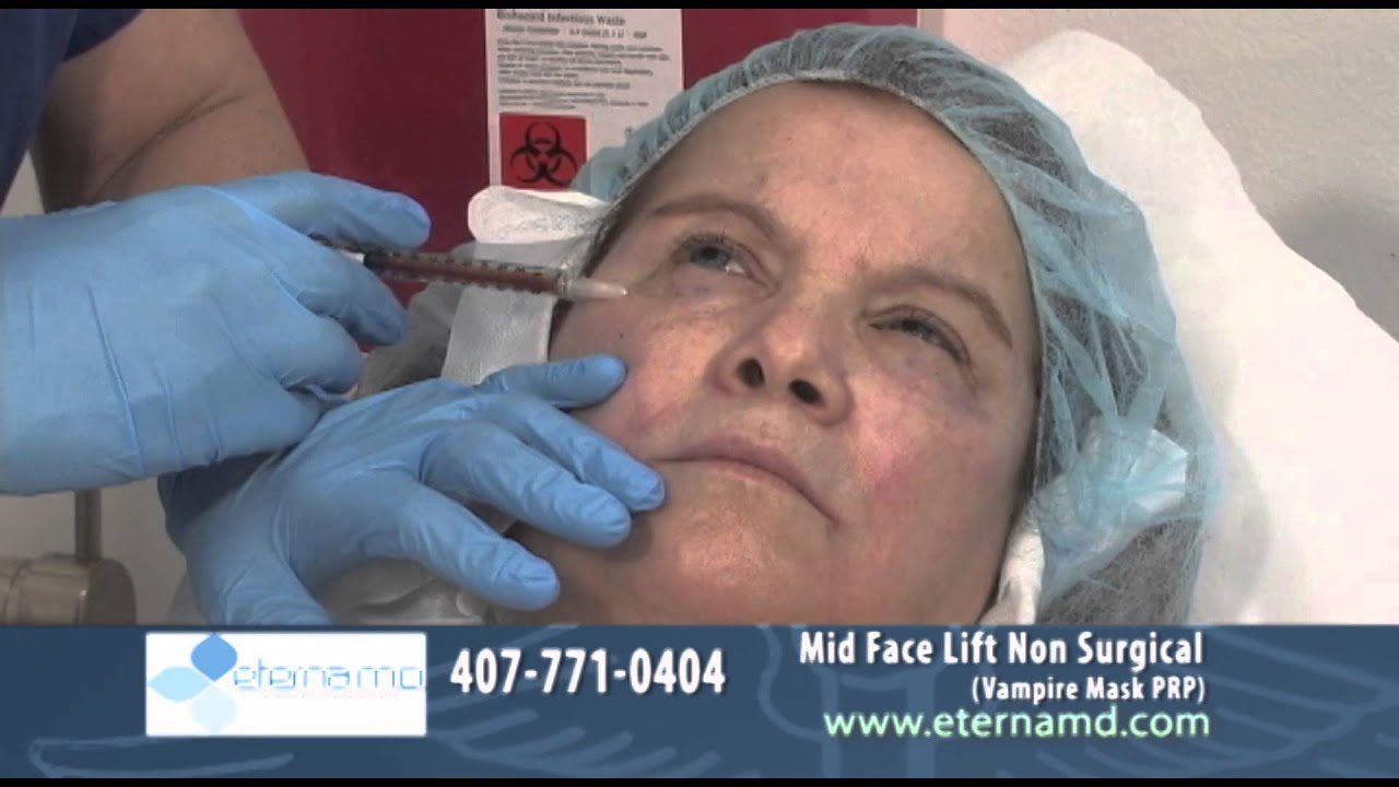 3 | Mid Face Lift Non Surgical With Vampire Mask PRP | Eterna MD - YouTube