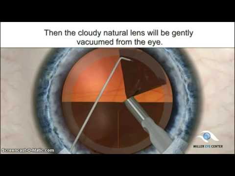 femtosecond cataract surgery