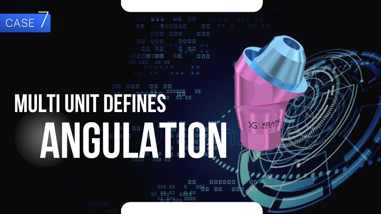 The angulated V-Type Multi Unit defines angulation of the future screw ...