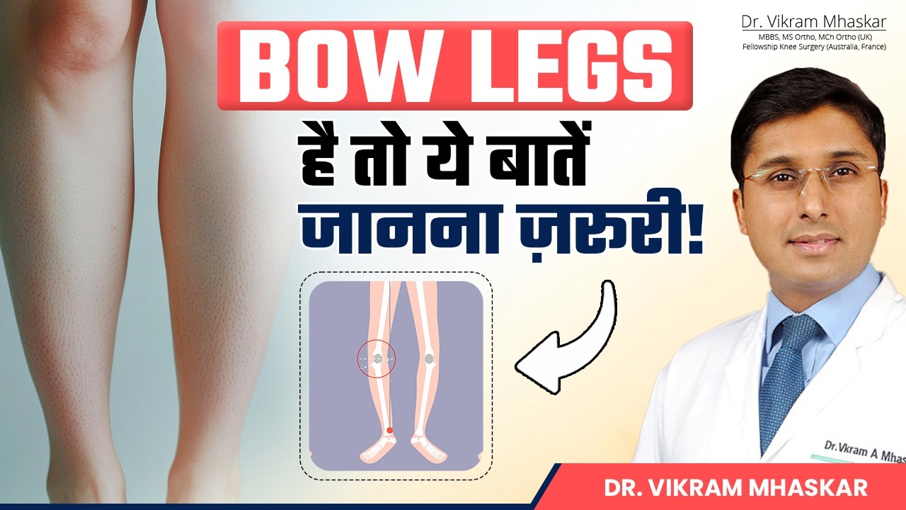 Bow Legs Problem जानिए कारण, लक्षण और इलाज | Bow Legs Treatment | Dr ...