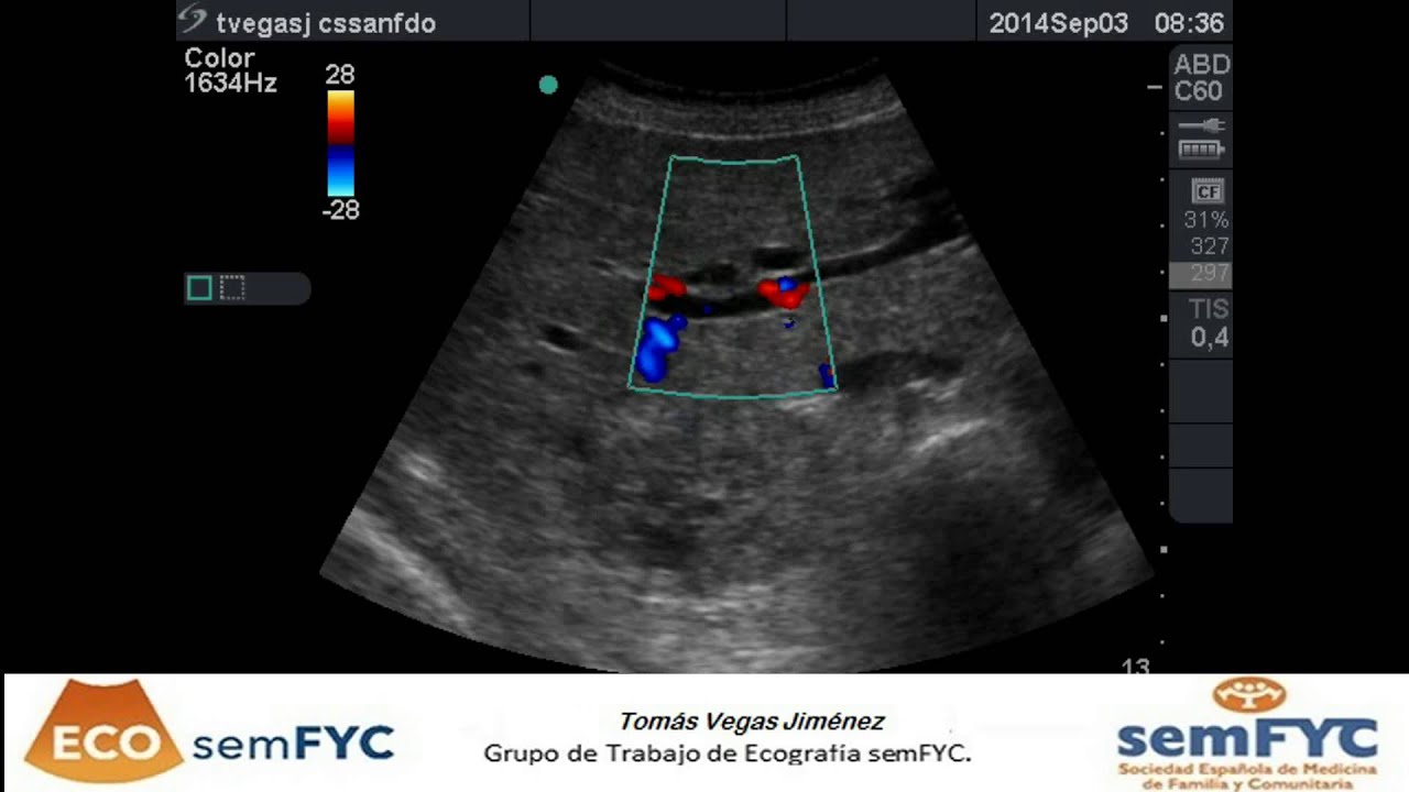 Dilatación via biliar - YouTube