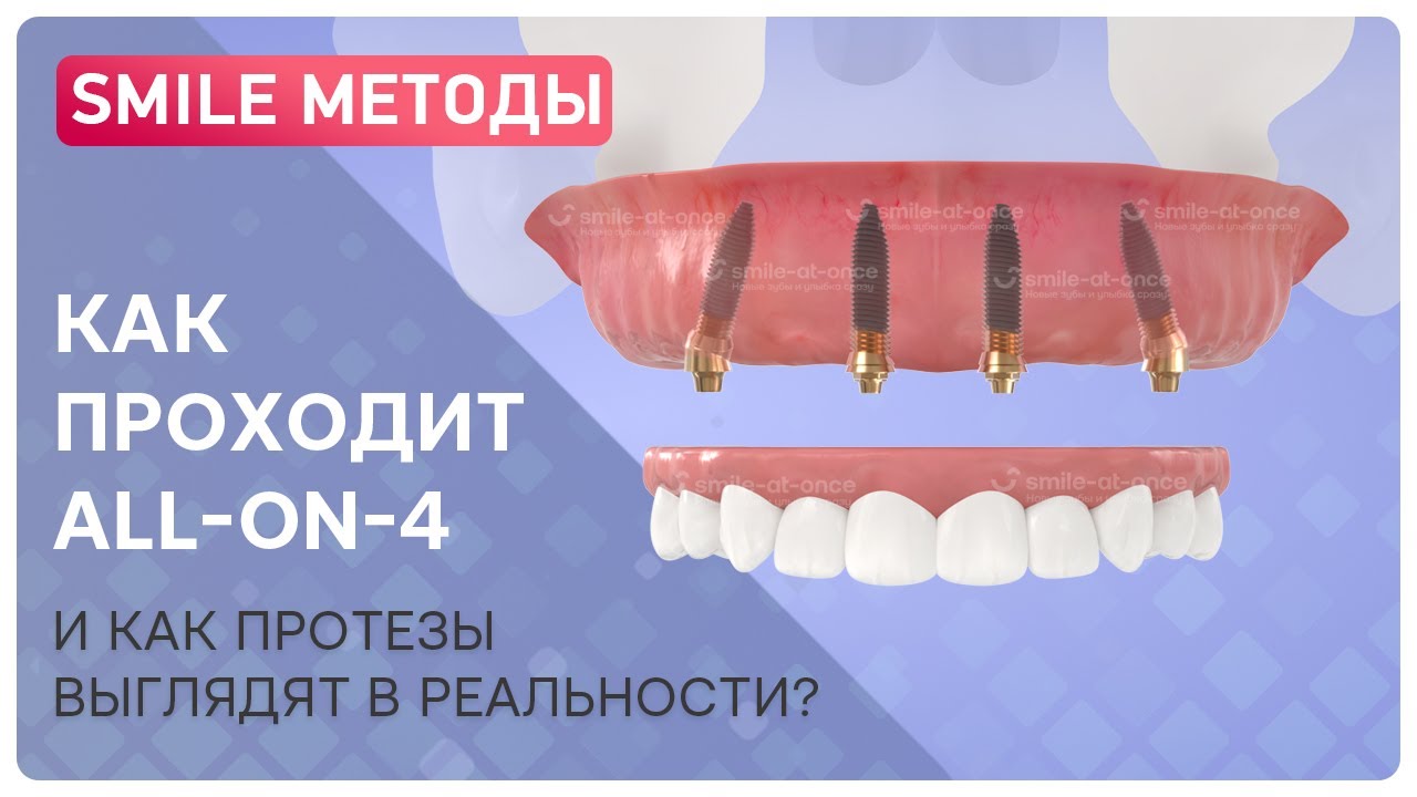Что такое all-on-4? Видео об имплантации на 4 имплантах, как смотрятся ...